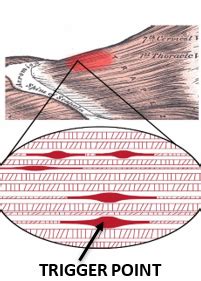 Trigger Point Injections Bellevue Pain Institute