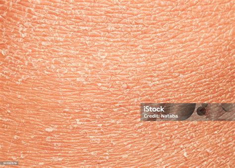 건강 하지 못한 인간의 피부 표 피 벗겨짐 텍스처와 금이 입자 클로즈업 피부에 대한 스톡 사진 및 기타 이미지 피부 껍질 건조한 Istock