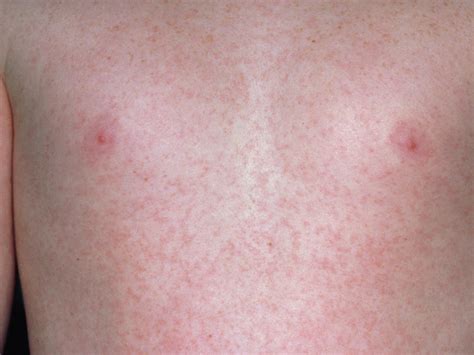 Small Red Spots On Belly