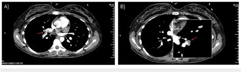 Bilateral Pulmonary Embolism On Ct Angiography A Filling Defect Download Scientific Diagram