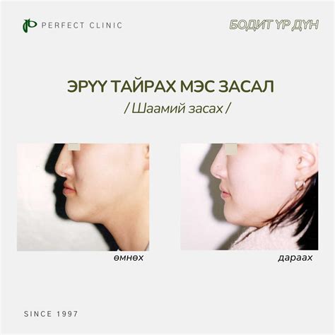 💡Бодит үр дүн ⏳28 Перфект эмнэлэг Perfect Clinic Facebook