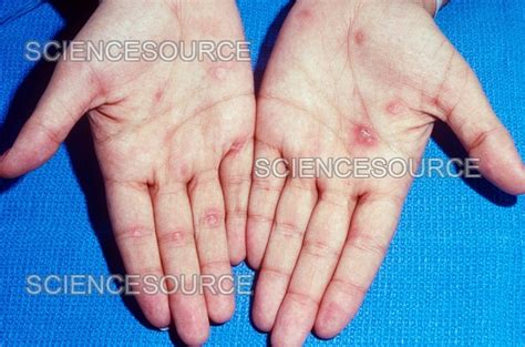 Secondary Syphilis Stock Image Science Source Images