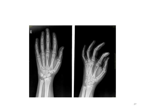 Age Estimation By Radiological Method Using X Rays Pptx