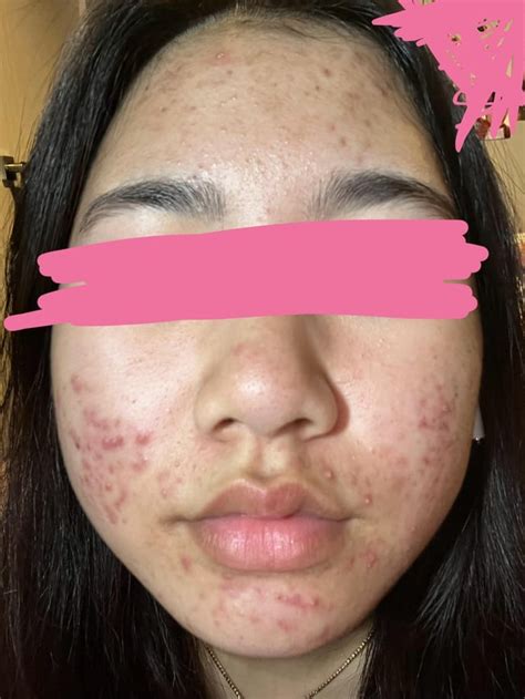 What To Do After Doxycycline R Acne