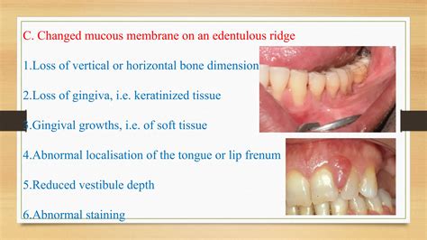 Periodontal Diseases Classification Pptx Dental Health Diseases And Conditions