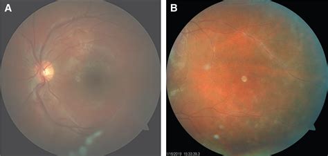 Pars Planitis Clinical Tree