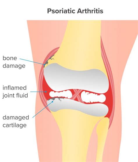 Common Types Of Arthritis That Affect The Knee Cyriaxphysio