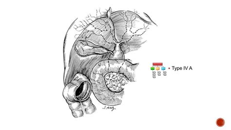 Choledochal Cysts Introduction Classification Pathogenesis And Management Pptx