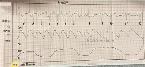 Trifascicular Block Ecg Guru Instructor Resources