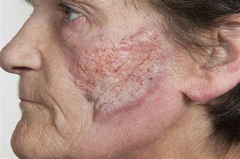 Disfiguring Facial Pyoderma Vegetans With An Excellent Outcome Bmj