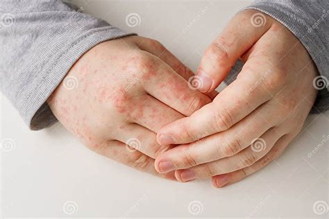 Male Hands On White Table With Red Spots On Skin Allergic Reaction