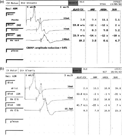 A Ulnar Nerve Motor Conduction In The First Evaluation Of A Patient Download Scientific