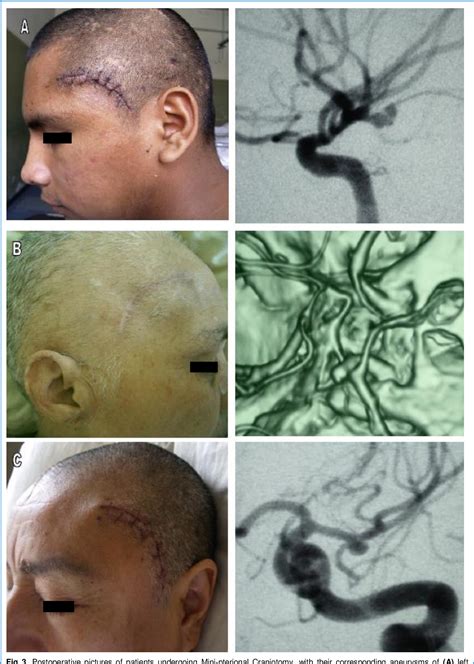 Figure 3 From Mini Pterional Craniotomy For Clipping Of Anterior
