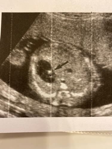 OB 2 Final Flashcards Quizlet