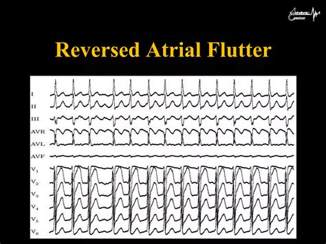 Ablation Of Atypical Flutter Pptx