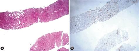 Benign Hepatocellular Nodules Of Healthy Liver Focal Nodular Hyperplasia And Hepatocellular