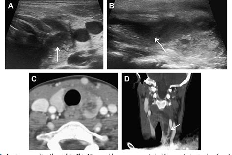 Table 1 From Thyroid Ultrasound Part 1 Technique And Diffuse Disease Semantic Scholar