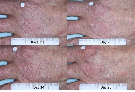 Taming Staphylococcus Aureus In The Eczema Skin Microbiome