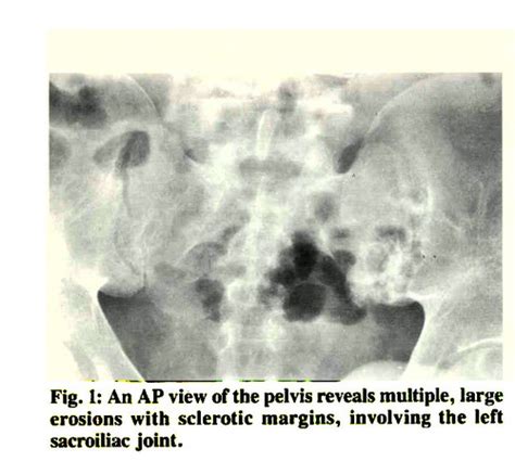 Sacroiliac Joint Erosion