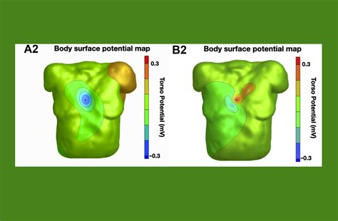 Using Ai To Predict Atrial Fibrillation Earlier And More Accurately