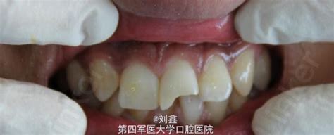外伤冠折的修复 医联
