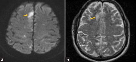 Acute Spasticity Secondary To Ischemic Stroke Involving Superior