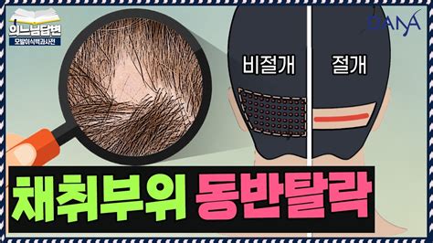 의느님답변📂모발이식 후 나타나는 부작용과 대처 방법은ㅣ모발이식 후 채취부위 동반탈락ㅣ다나성형외과danaㅣ모발이식ㅣ헤어라인교정ㅣ두피문신ㅣ탈모치료 Youtube