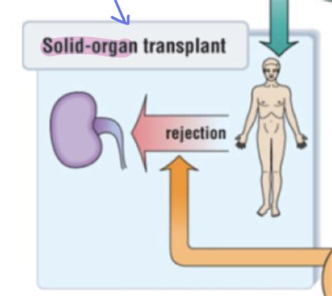 Transplantation Flashcards Quizlet