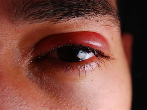 Cellulitis Treatment