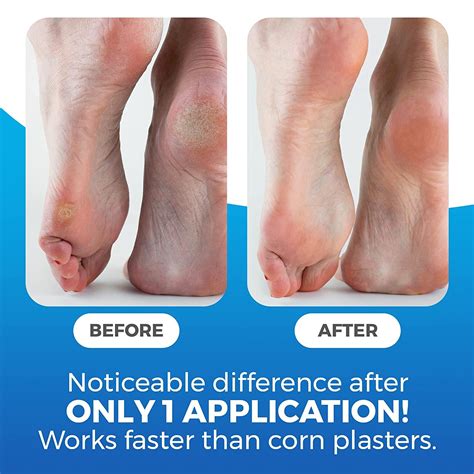 Foot Callus Remover With Salicylic Acid Extra Strength Corn Remover