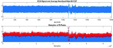 R Peak Detection Of Abnormal Ecg Signals Download Scientific Diagram