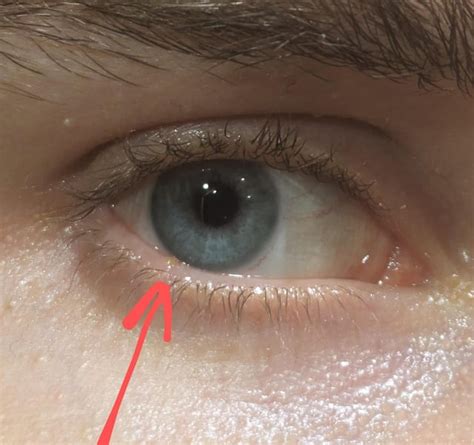 How Do You Stop Glands From Getting Capped Clogged R Dryeyes