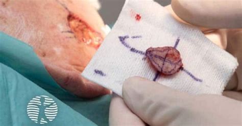 Mohs Excision Image