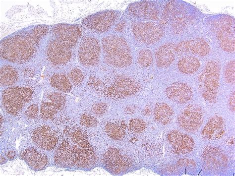 Pathology Walker Auto Tweet Bot On Twitter ②immunostains Of