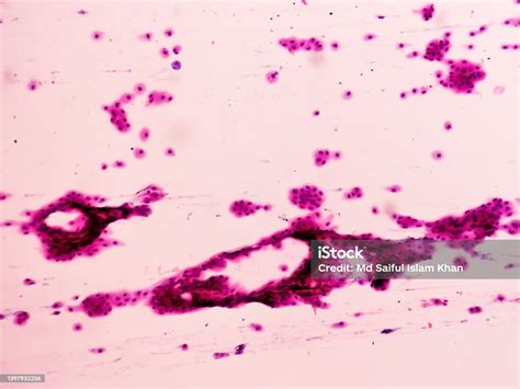 Pap의 얼룩 Pap 얼룩 현미경 보기는 고급 편평 상피 내 병변이 전암성 성병임을 보여줍니다 Hpv 백신에 대한 스톡 사진 및 기타 이미지 Istock