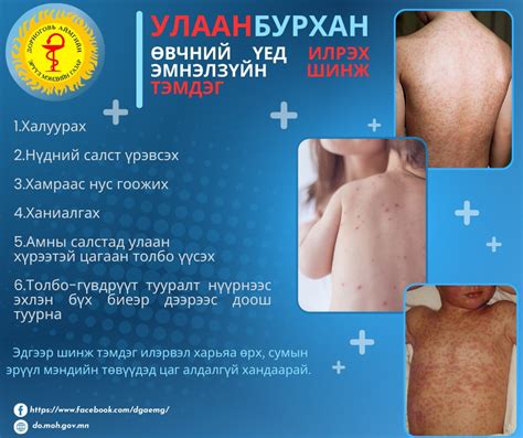 Дорноговь аймгийн Эрүүл мэндийн газар Улаанбурхан өвчний үед илрэх шинж тэмдэг👇 👉Халуурах 🤒 👉