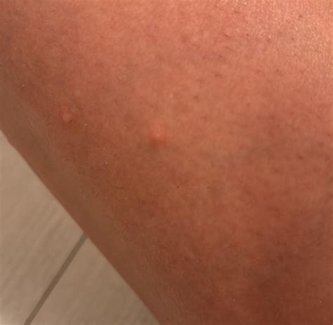 Bed Bug Bites Theyre Very Itchy And Wondering What People Think R