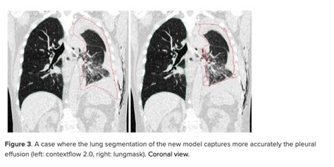 Improving Lung Segmentation For Higher Coverage Of Clinically Relevant Findings A Contextflow