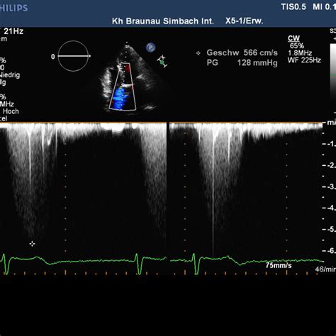 Two Dimensional Transesophageal Echocardiogram Shows The Gerbode Defect