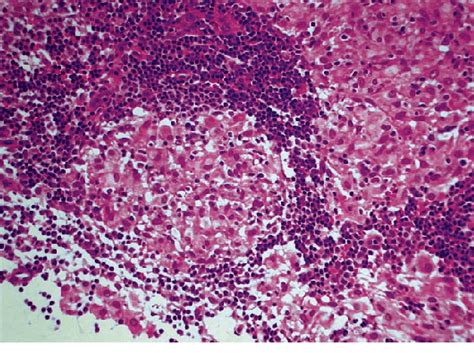 Pathology Of Left Paratracheal Lymph Nodes Of Case 1 Shows Chronic