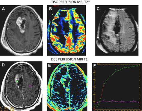 Magnetic Resonance Perfusion And Permeability Imaging In Brain Tumors