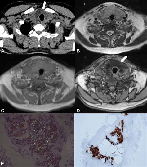 A Axial Thoracic Ct Reveals An Enlarged Thyroid Gland With Diffuse Download Scientific Diagram