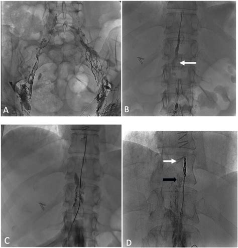 Thoracic Duct Embolization Via Percutaneous Puncture Of The Cisterna Download Scientific