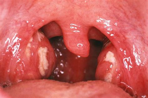 Granular Pharyngitis