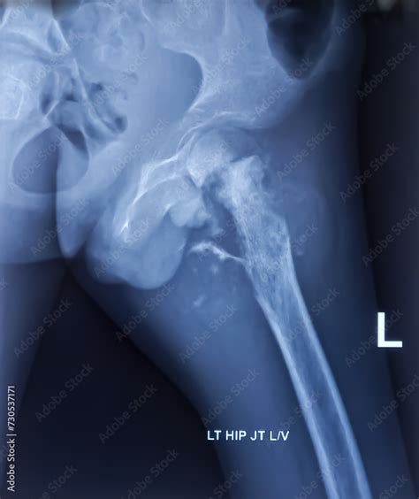 X Ray Of Pelvis Chronic Osteomyelitis Involving Proximal Shaft And Neck Of The Femur Defused