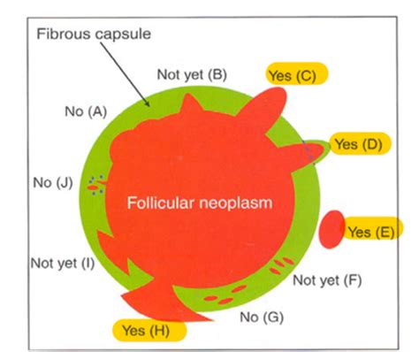 Thyroid Cap Flashcards Quizlet Thyroid Cap Flashcards Quizlet