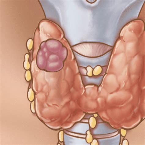 Well Differentiated Thyroid Cancer THANC Guide