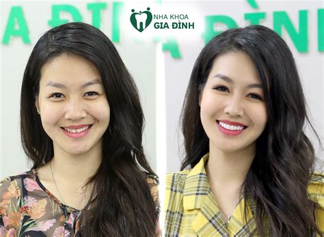 Mc Hồng Nhung thần thái sau khi tân trang nụ cười