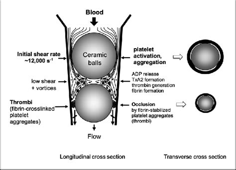 Schematic Showing The Principle Of Thrombus Formation In The Global