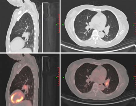 Positron Emission Tomography Computed Tomography Of Case 2 A Download Scientific Diagram